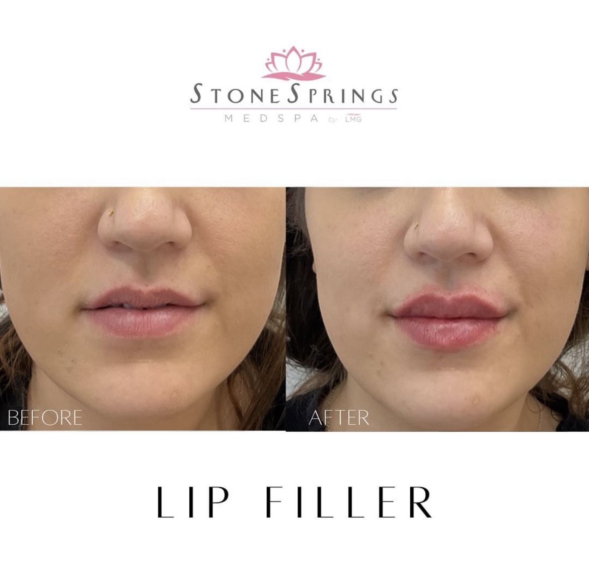 Facial Fillers - Stone Springs MedSpa by LMG