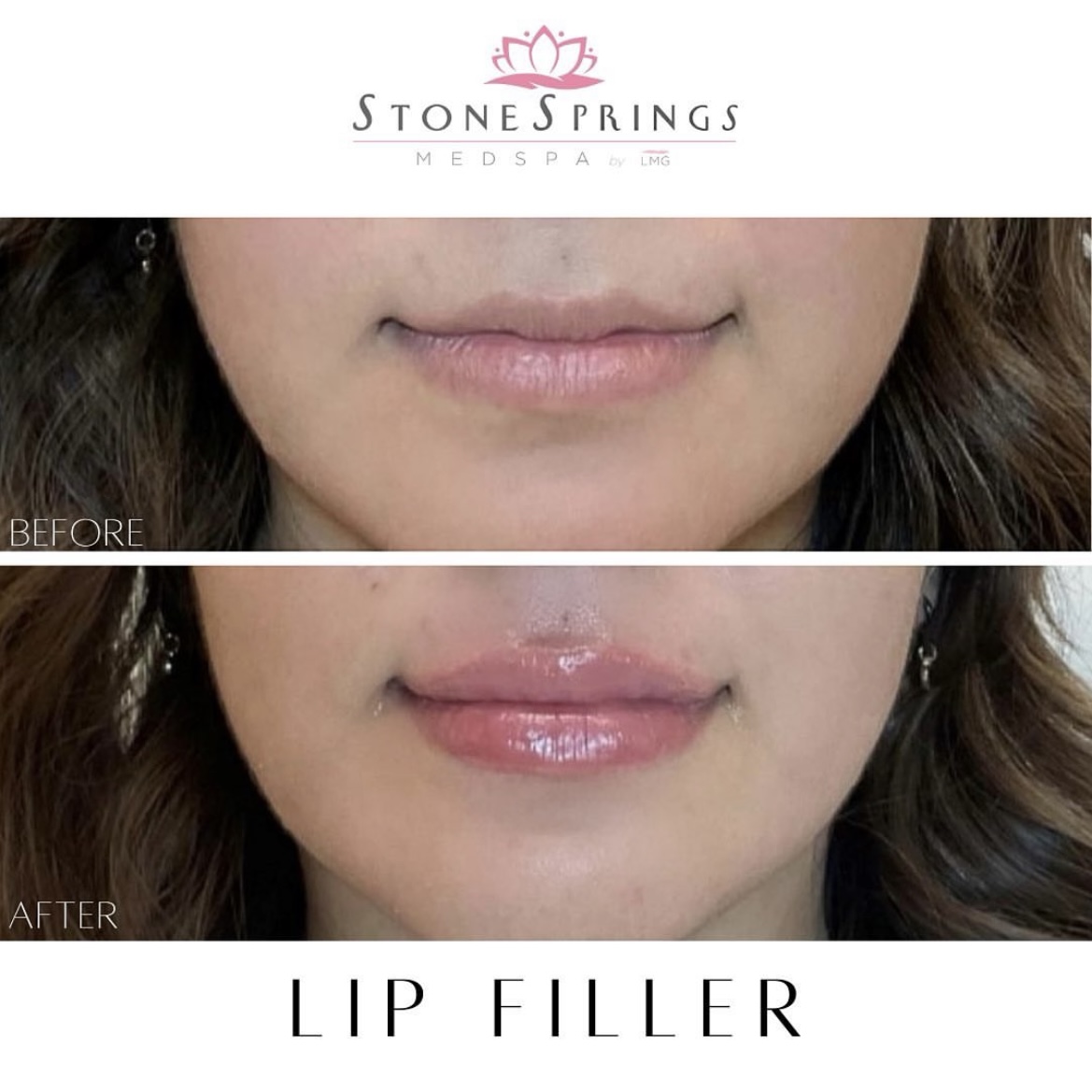 Facial Fillers - Stone Springs MedSpa by LMG